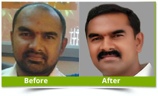 Hair Transplant, India - Dr. Dinesh Govind Gowda
